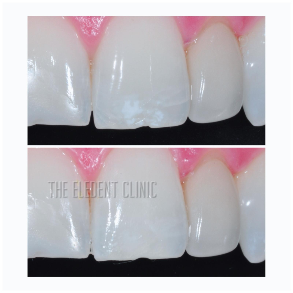 Icon White Spot Treatment - Eledent - Dentist in Sutton Eledent ...